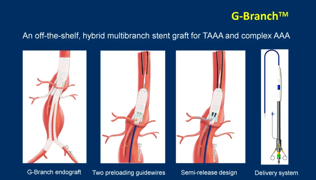 LifeTech Scientific Secures NMPA Approval for G‑Branch TAAA Stent‑Graft ...